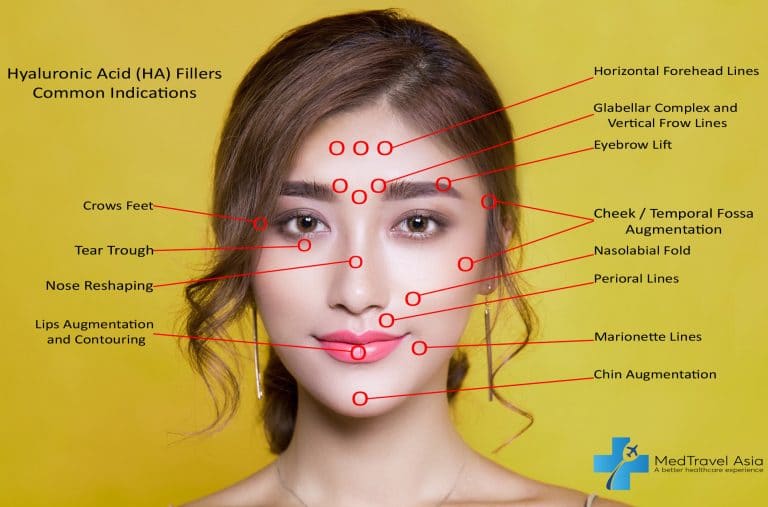 Hyaluronic Acid Fillers: Cosmetic Uses of HA - MedTravel Asia
